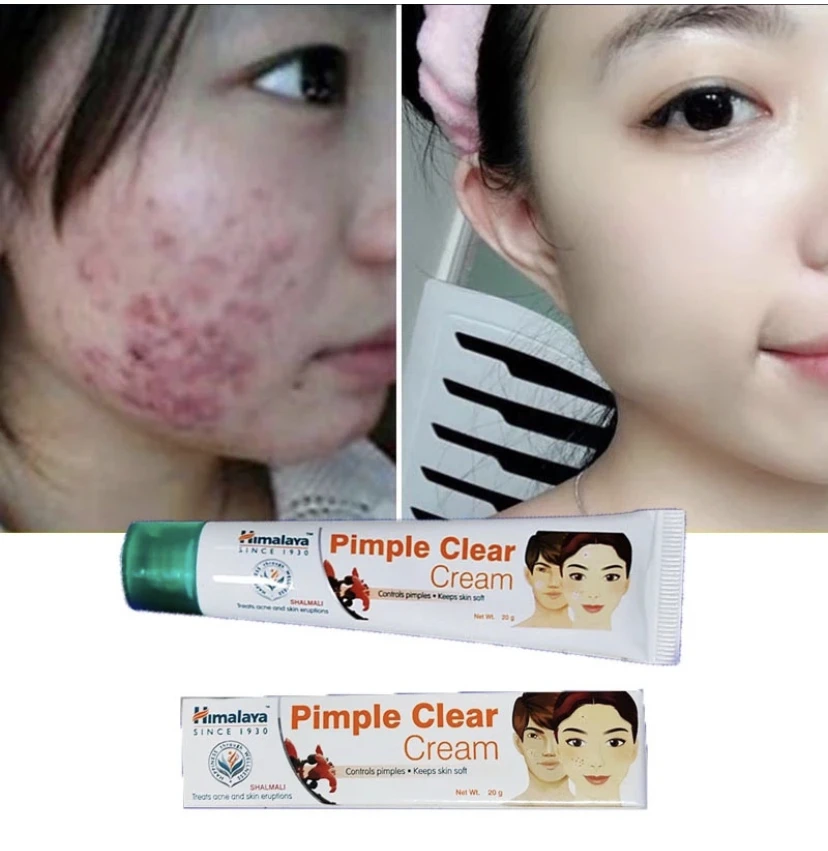Himalaya pimple marks removal cream store